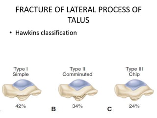 Types Of Talus Fractures