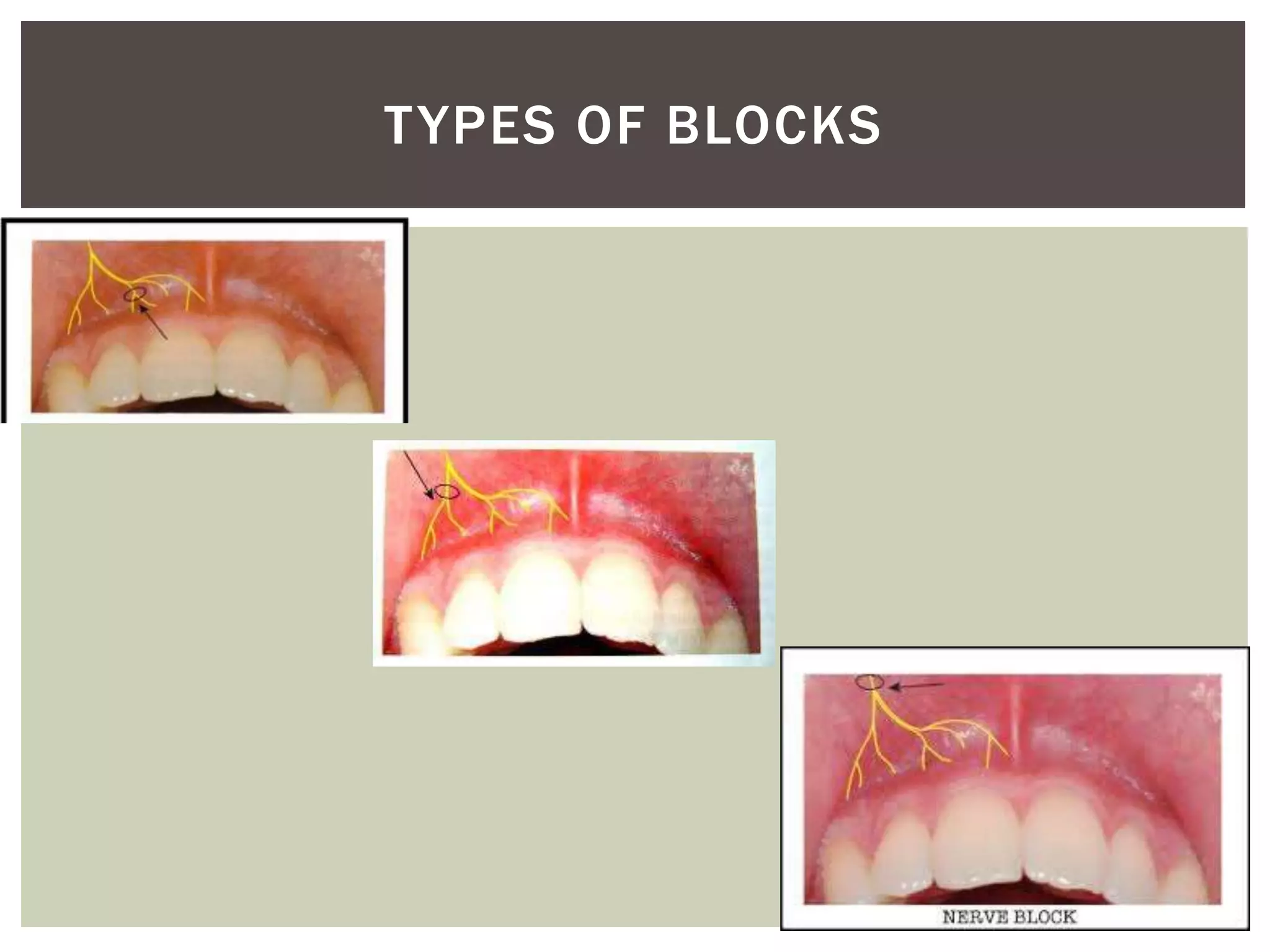 Local anaesthesia - Basics in dentistry | PPTX