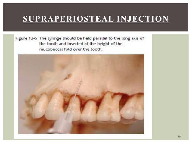Local anaesthesia - Basics in dentistry | PPTX