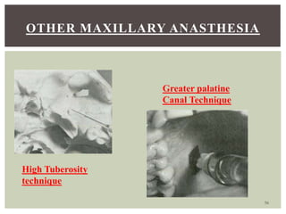 Local anaesthesia - Basics in dentistry | PPTX