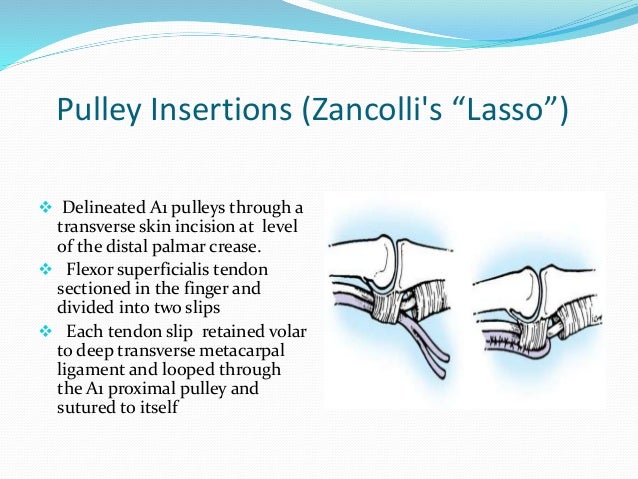 management of claw hand