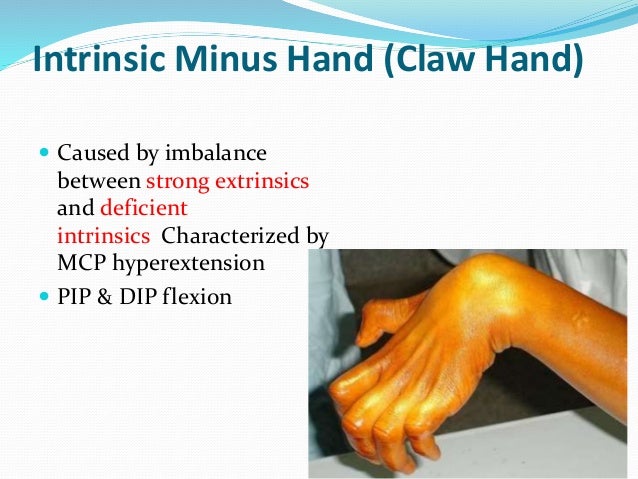 management of claw hand