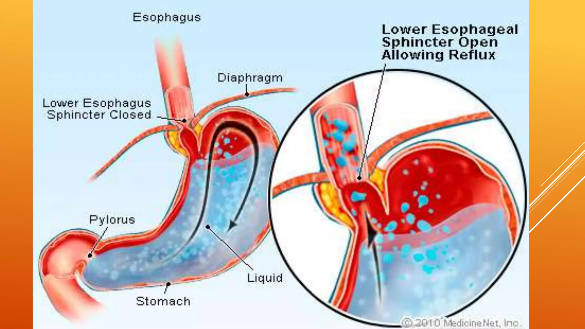 Gastroesophageal reflux disease (GERD) | PPTX