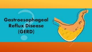 Gastroesophageal reflux disease (GERD) | PPTX