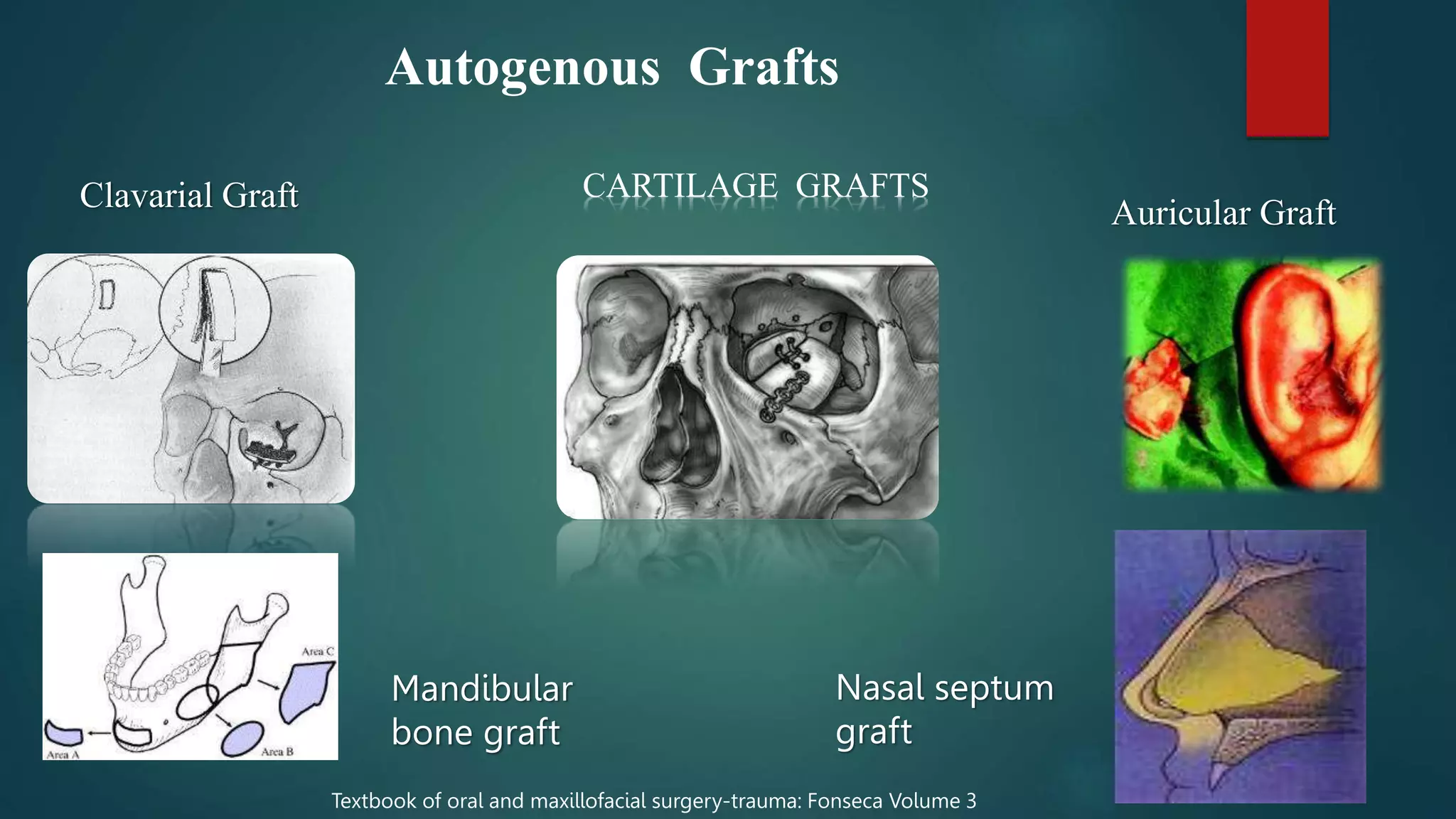 Prateshbhai - orbital floor fracture (1).pptx