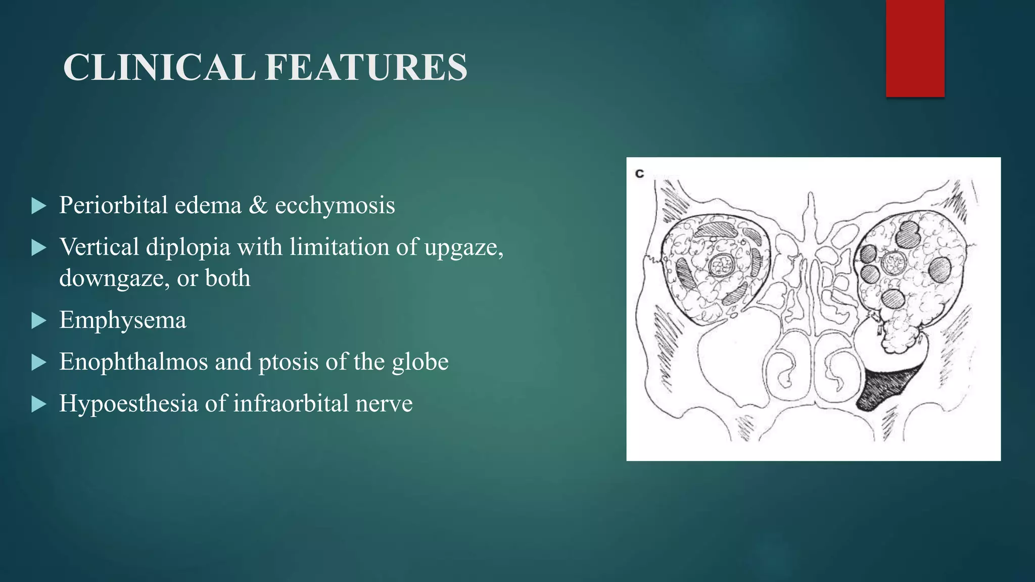 Prateshbhai - orbital floor fracture (1).pptx