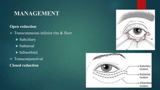 Prateshbhai - orbital floor fracture (1).pptx