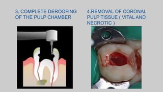 Root canal treatment - instruments jaiakshs | PPTX