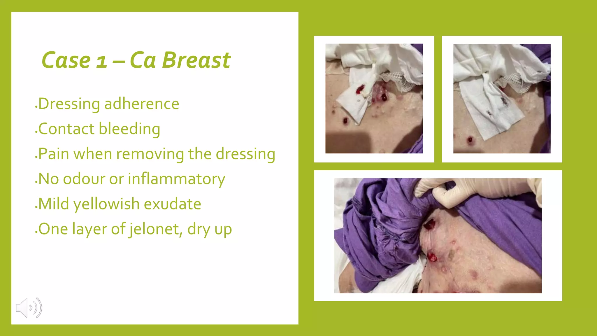 Malignant fungating wound education ppt | PPTX