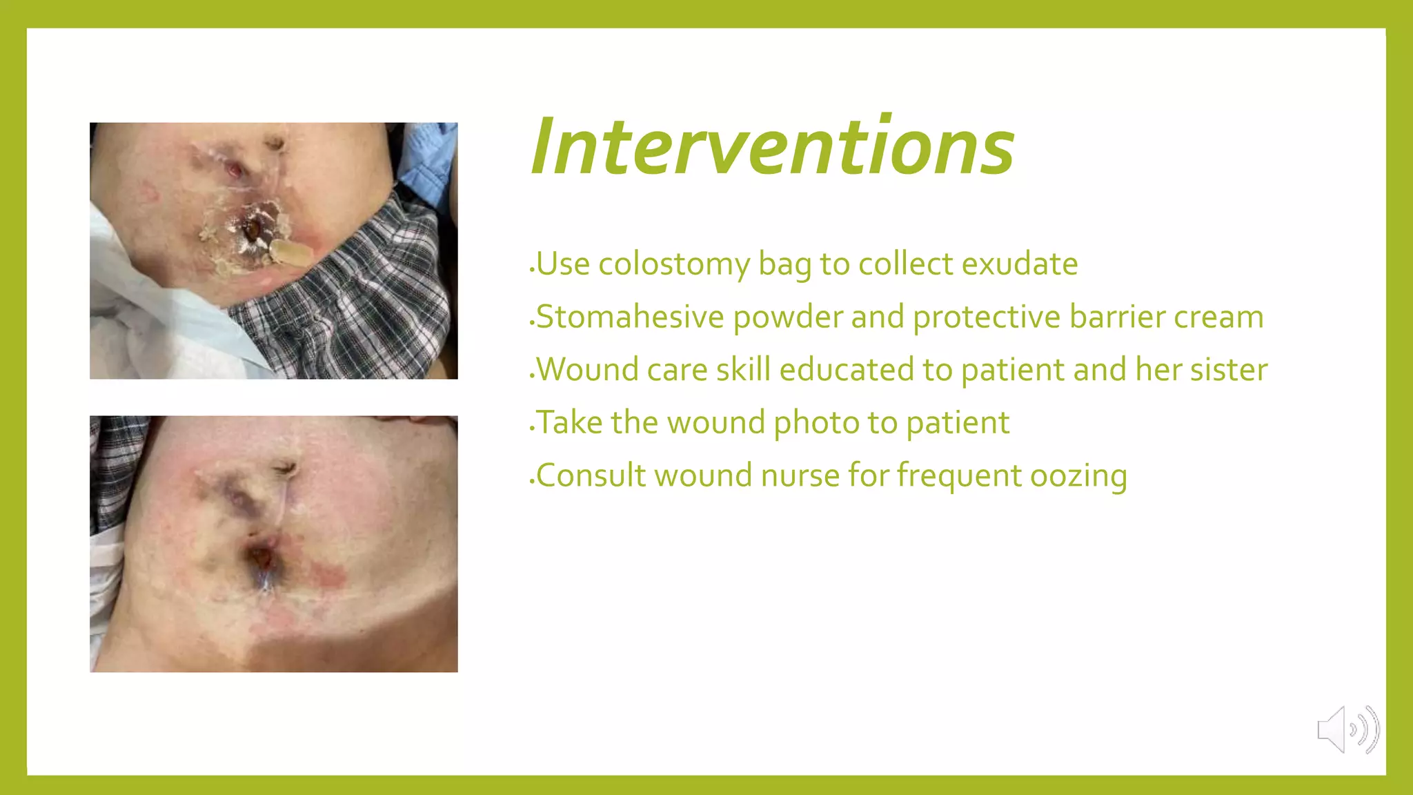 Malignant fungating wound education ppt | PPTX