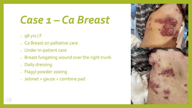 Malignant fungating wound education ppt