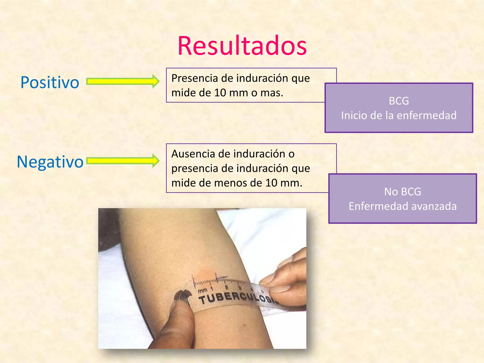Práctica12 intradermorreaccion tuberculina | PPTX