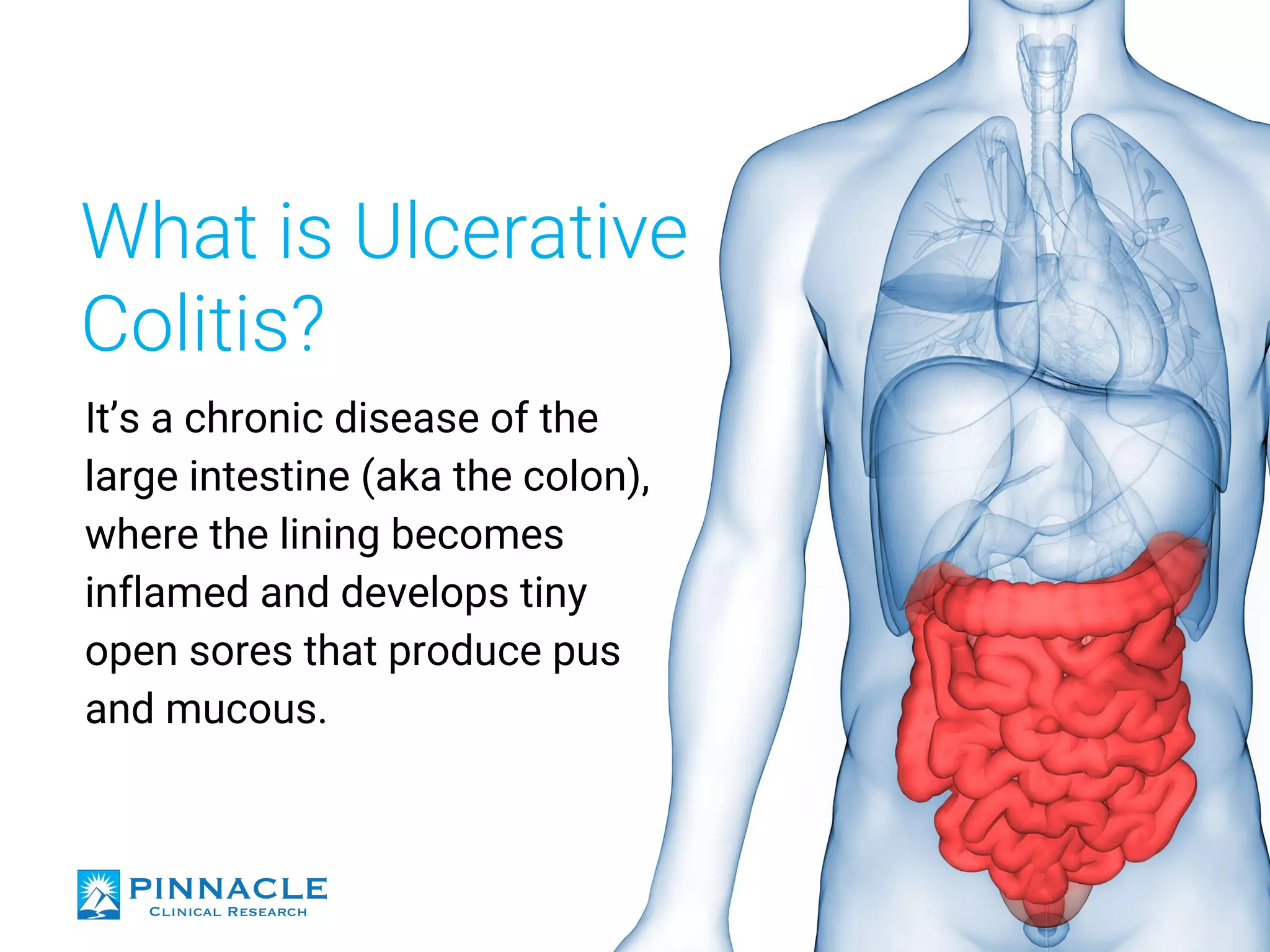 Understanding Ulcerative Colitis | PDF