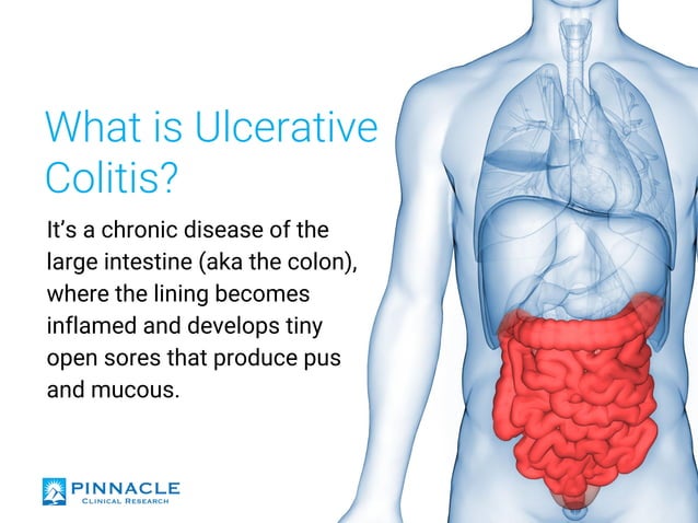 Understanding Ulcerative Colitis | PPT
