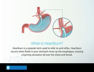Heartburn: Signs, Symptoms and Treatment Options | PDF
