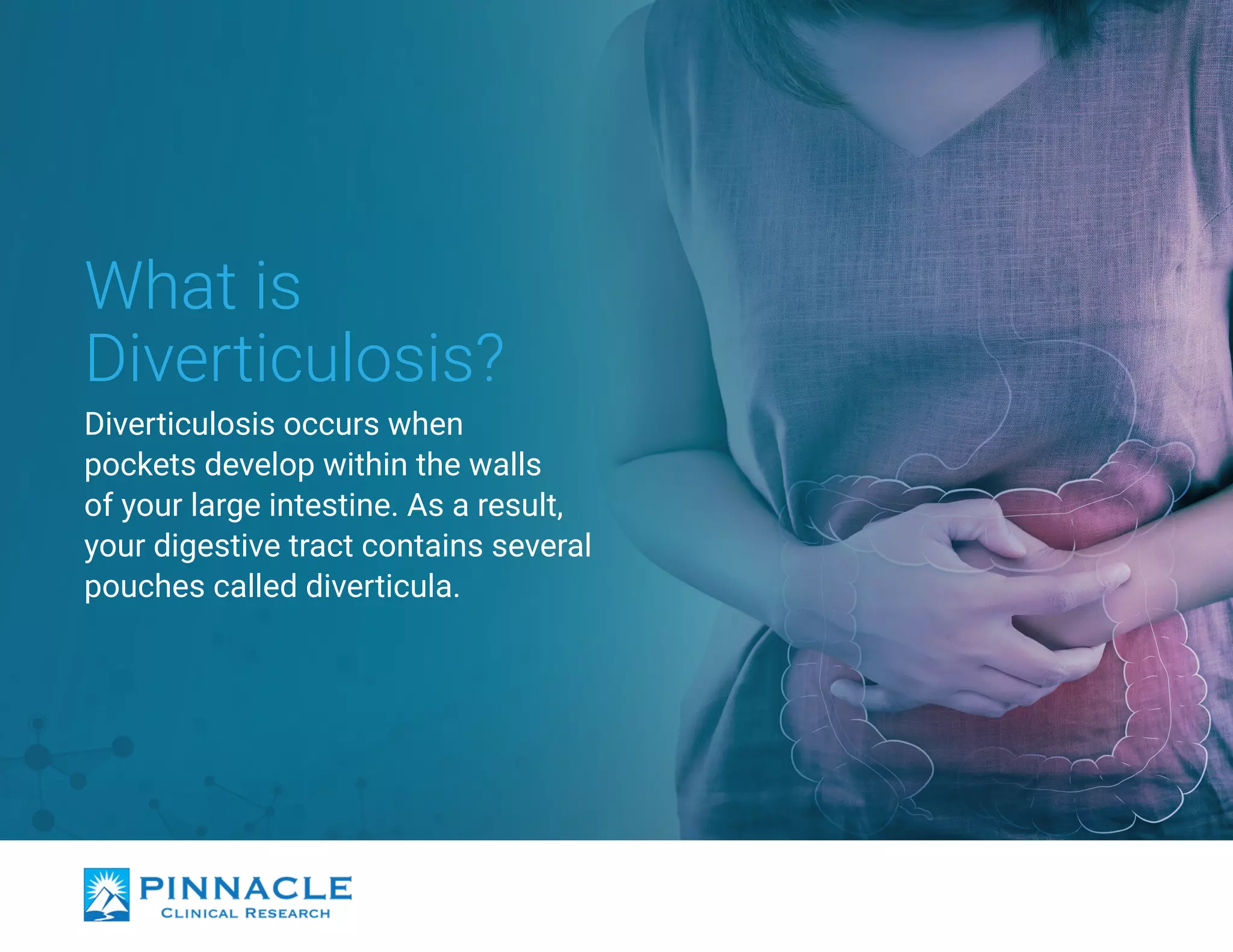 What is Diverticulosis? | PDF