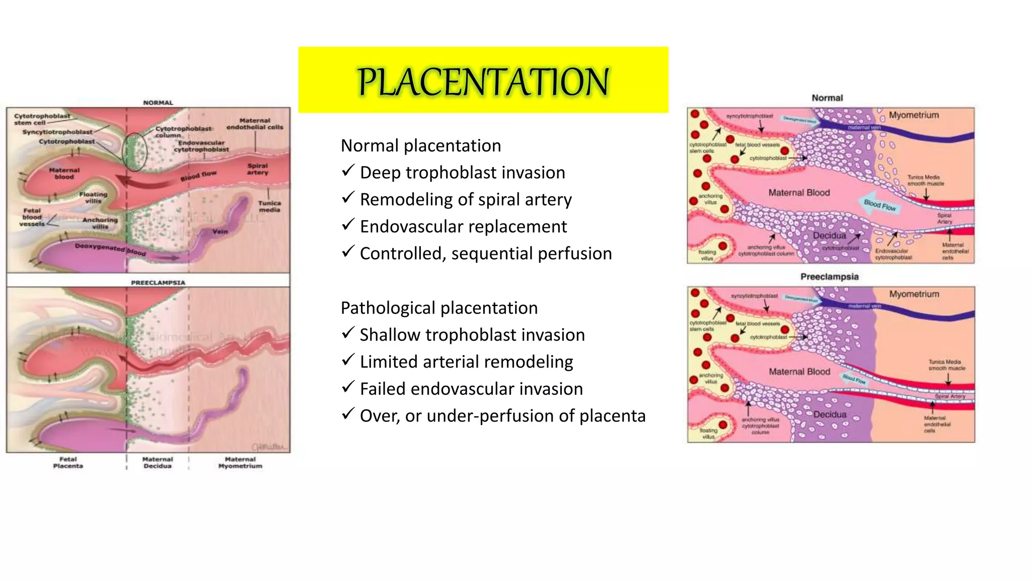 pathogenesis of Pre eclampsia | PPTX