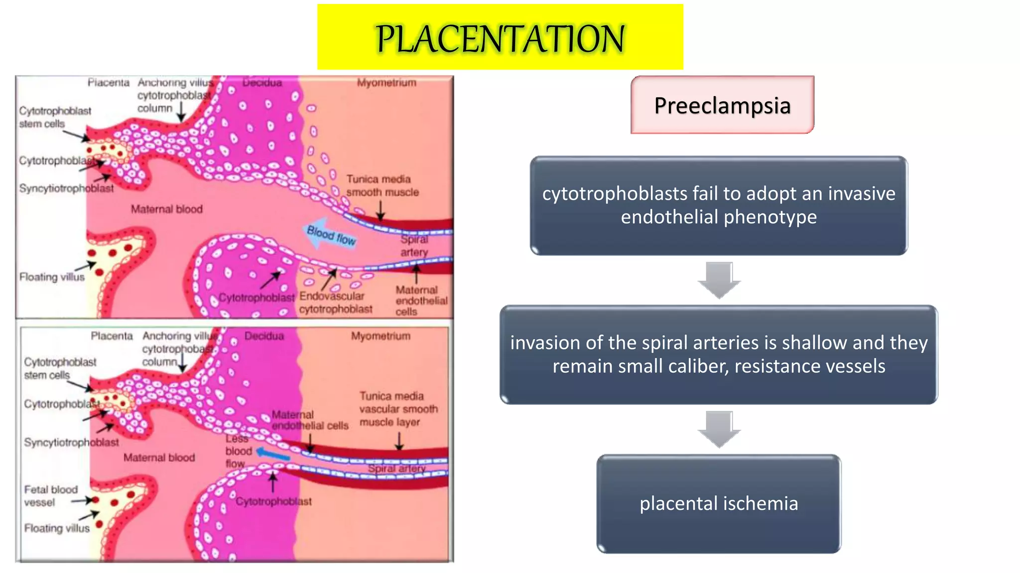 pathogenesis of Pre eclampsia | PPTX