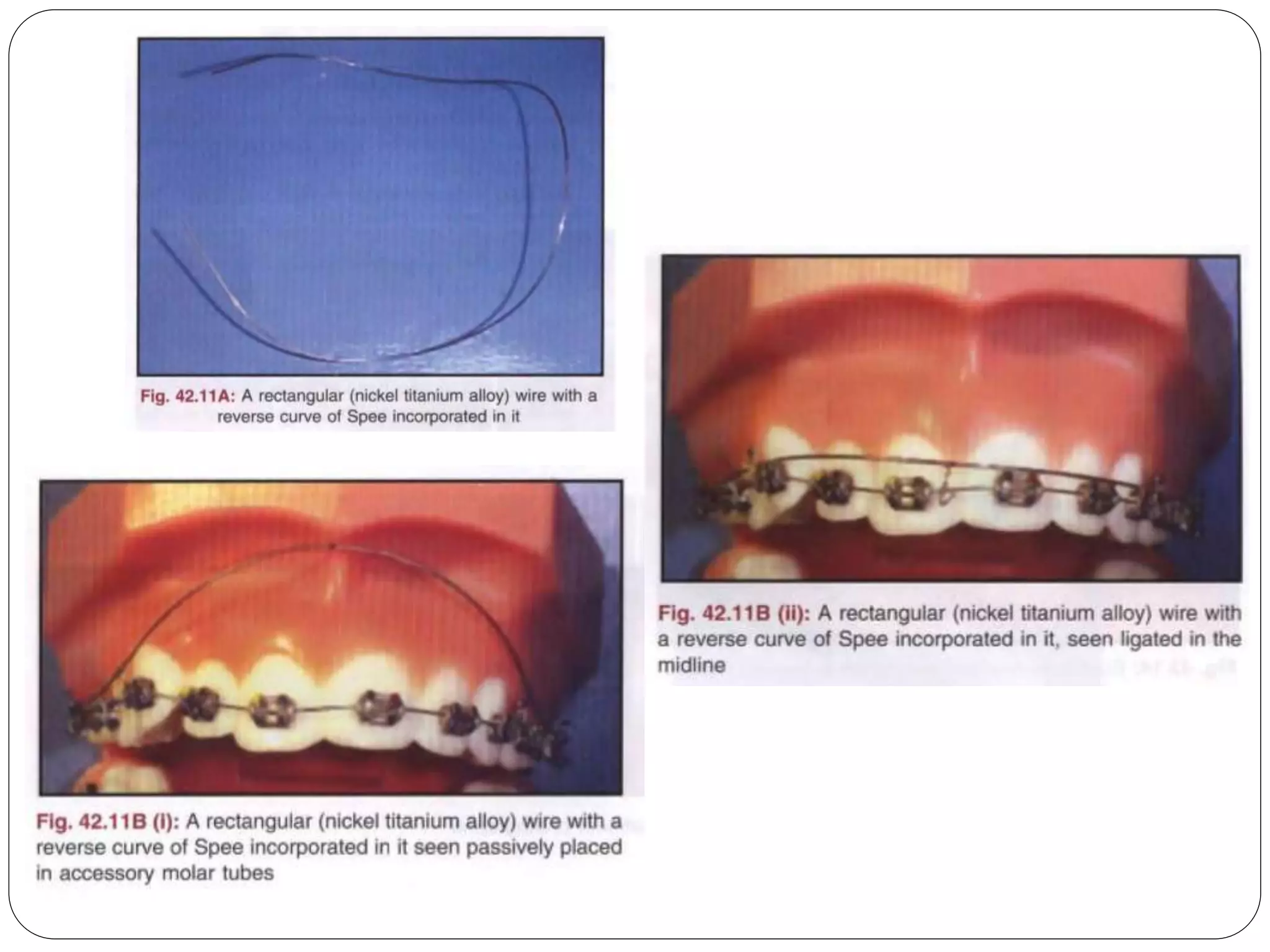 pre-adjusted edgewise appliance (PEA) | PPTX