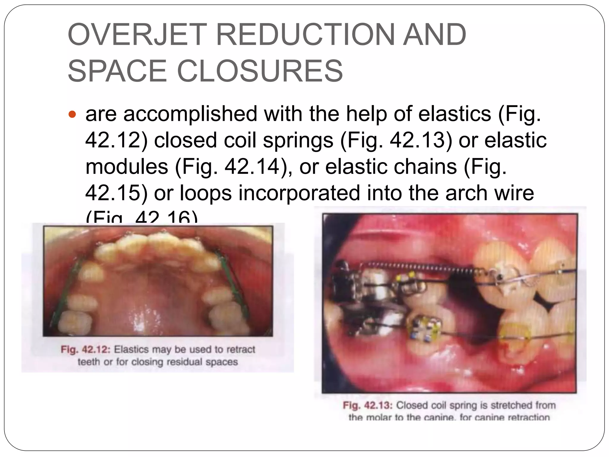 pre-adjusted edgewise appliance (PEA) | PPTX