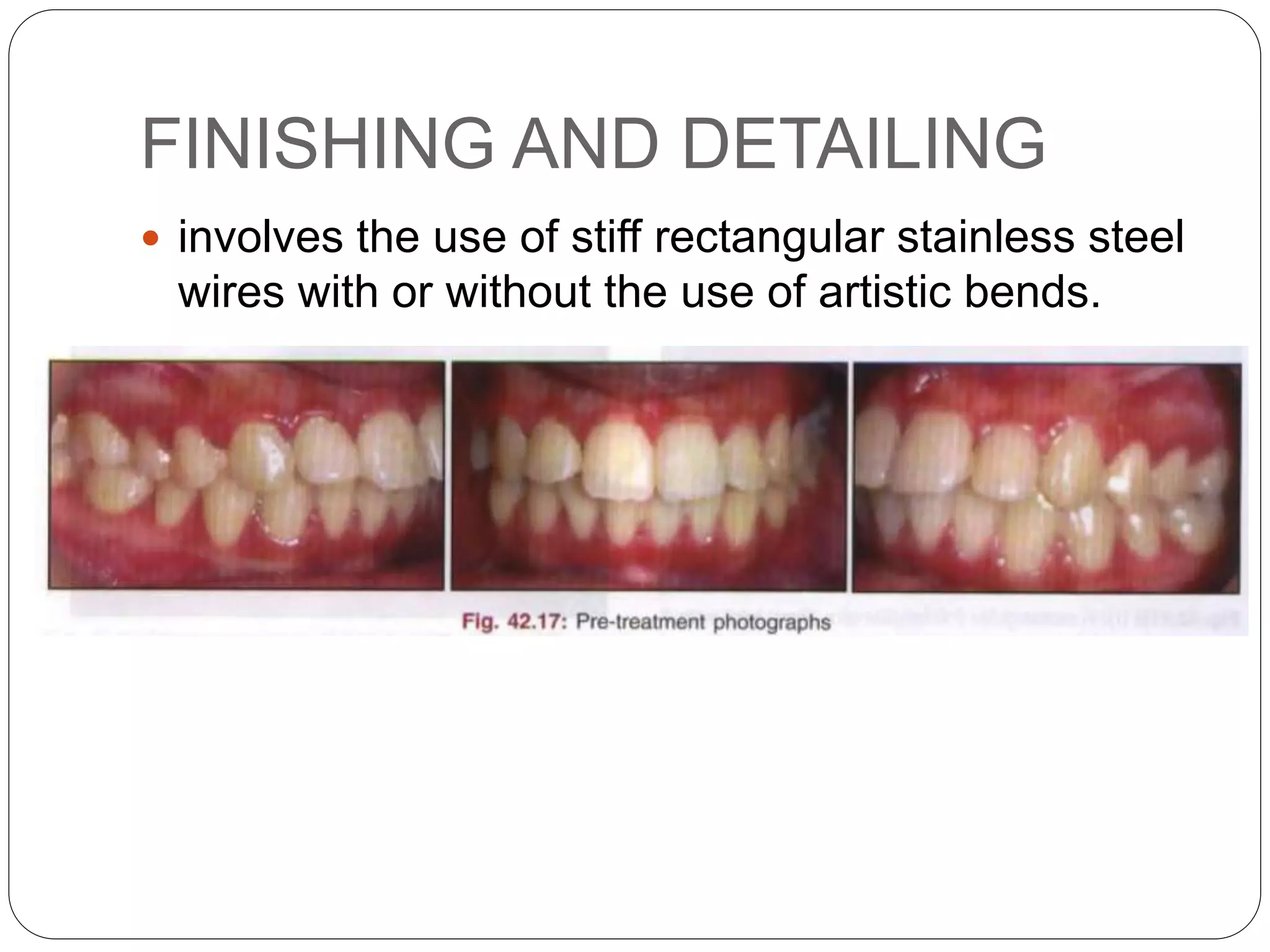 pre-adjusted edgewise appliance (PEA) | PPTX