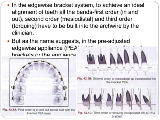 pre-adjusted edgewise appliance (PEA) | PPTX