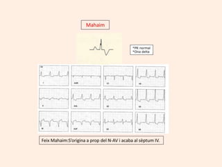 Pre excitation | PPTX