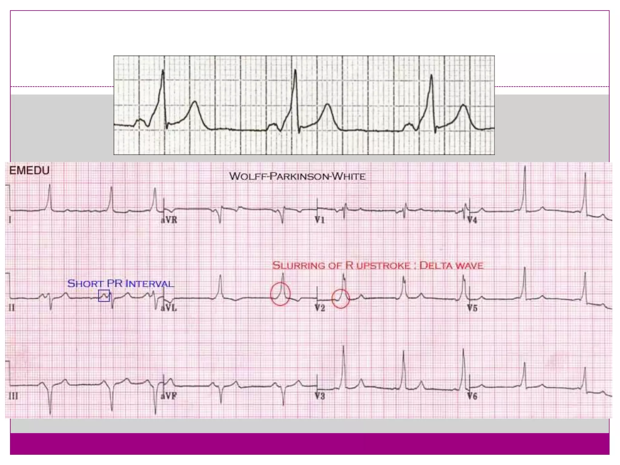 Basic of Pre-excitation syndrome | PPTX