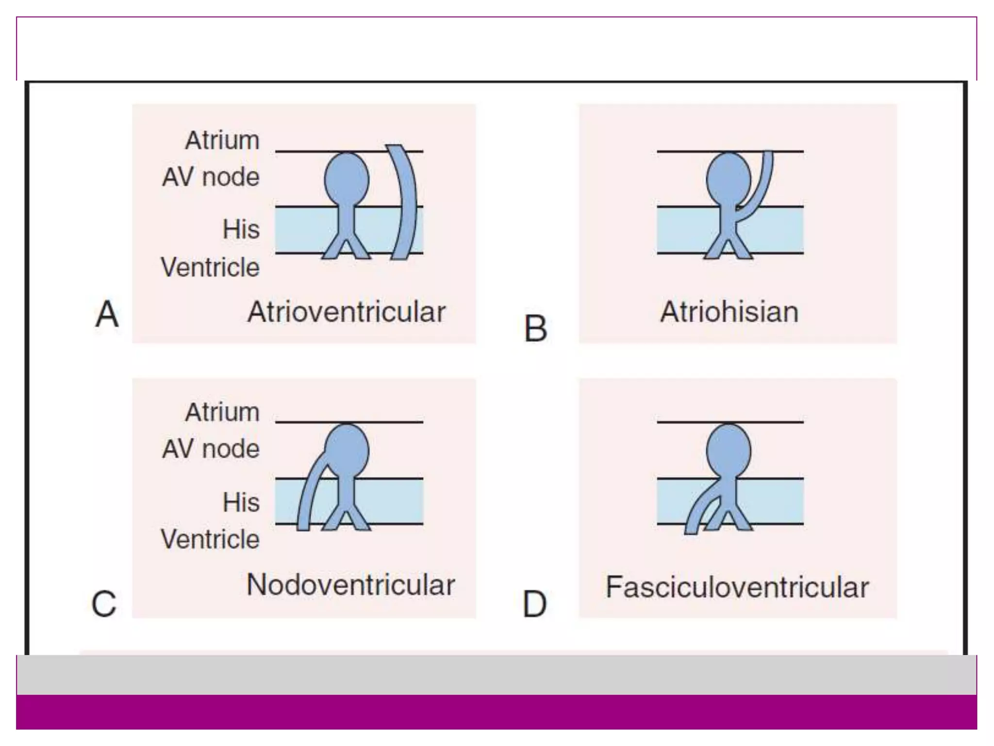 Basic of Pre-excitation syndrome | PPTX
