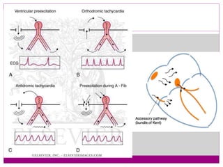 Basic of Pre-excitation syndrome | PPTX