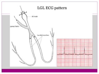 Basic of Pre-excitation syndrome | PPTX