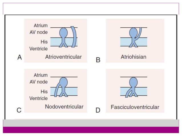 Basic of Pre-excitation syndrome | PPT