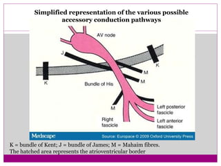 Basic of Pre-excitation syndrome | PPTX