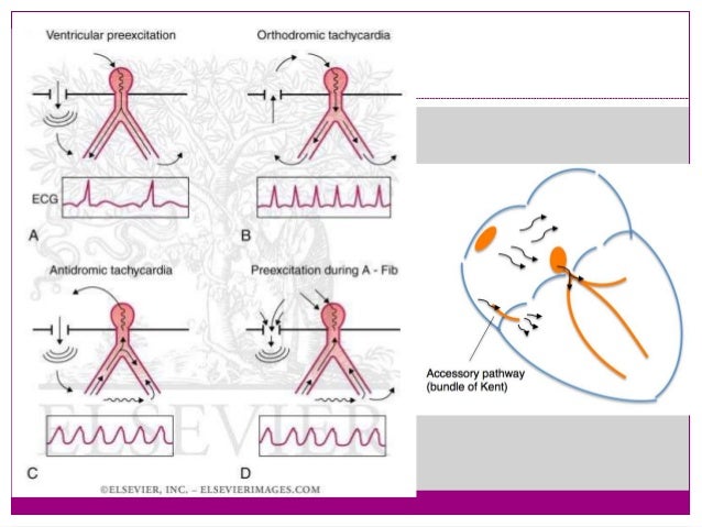 Basic of Pre-excitation syndrome