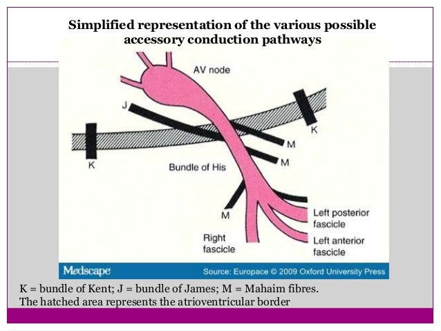 Basic of Pre-excitation syndrome