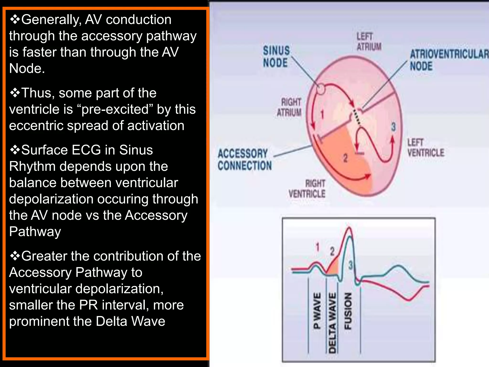 Pre-excitation Syndromes.ppt