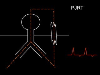 Pre-excitation Syndromes.ppt