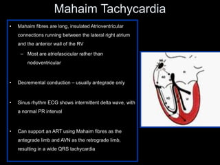 Pre-excitation Syndromes.ppt