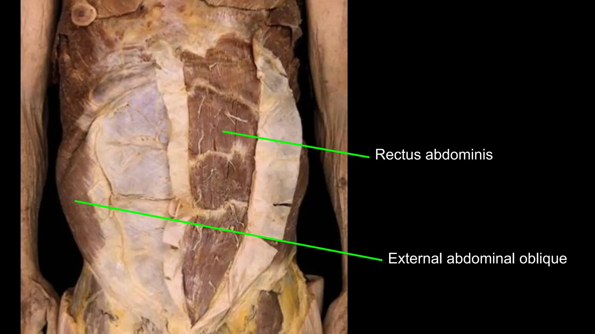 Skeletal Muscles on cadaver image and diagrams.pdf
