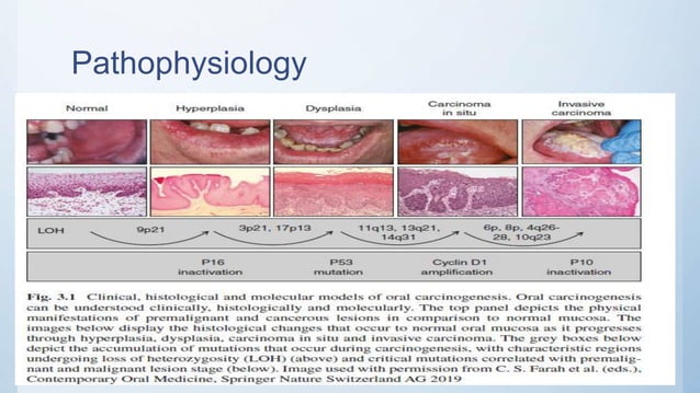 Pre-malignant Lesions of Oral mucosa.pptx | Dental Health | Diseases ...