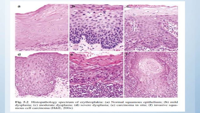 Pre-malignant Lesions of Oral mucosa.pptx | Dental Health | Diseases ...