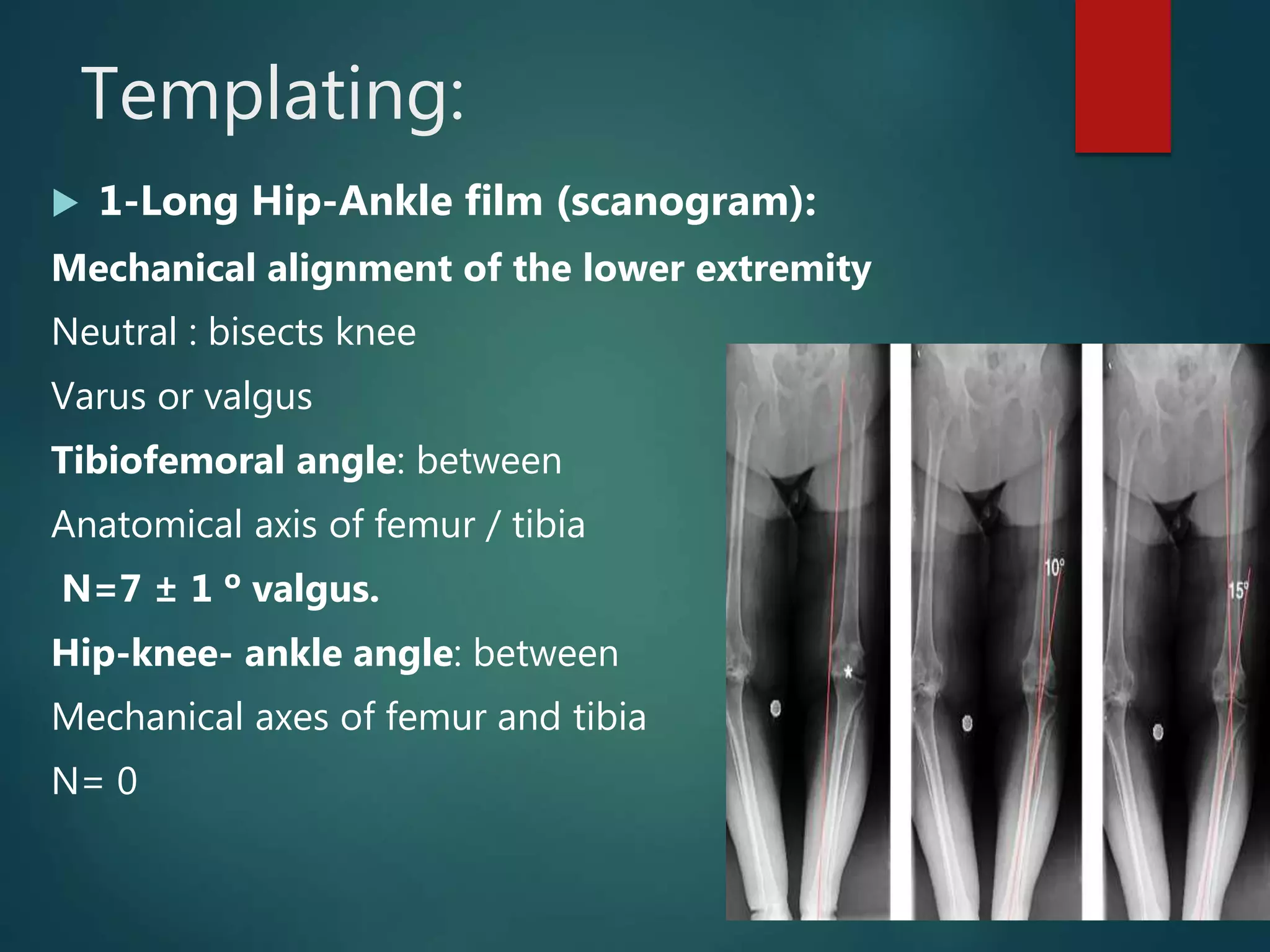 Preoperative preparation of total knee arthroplasty | PPTX