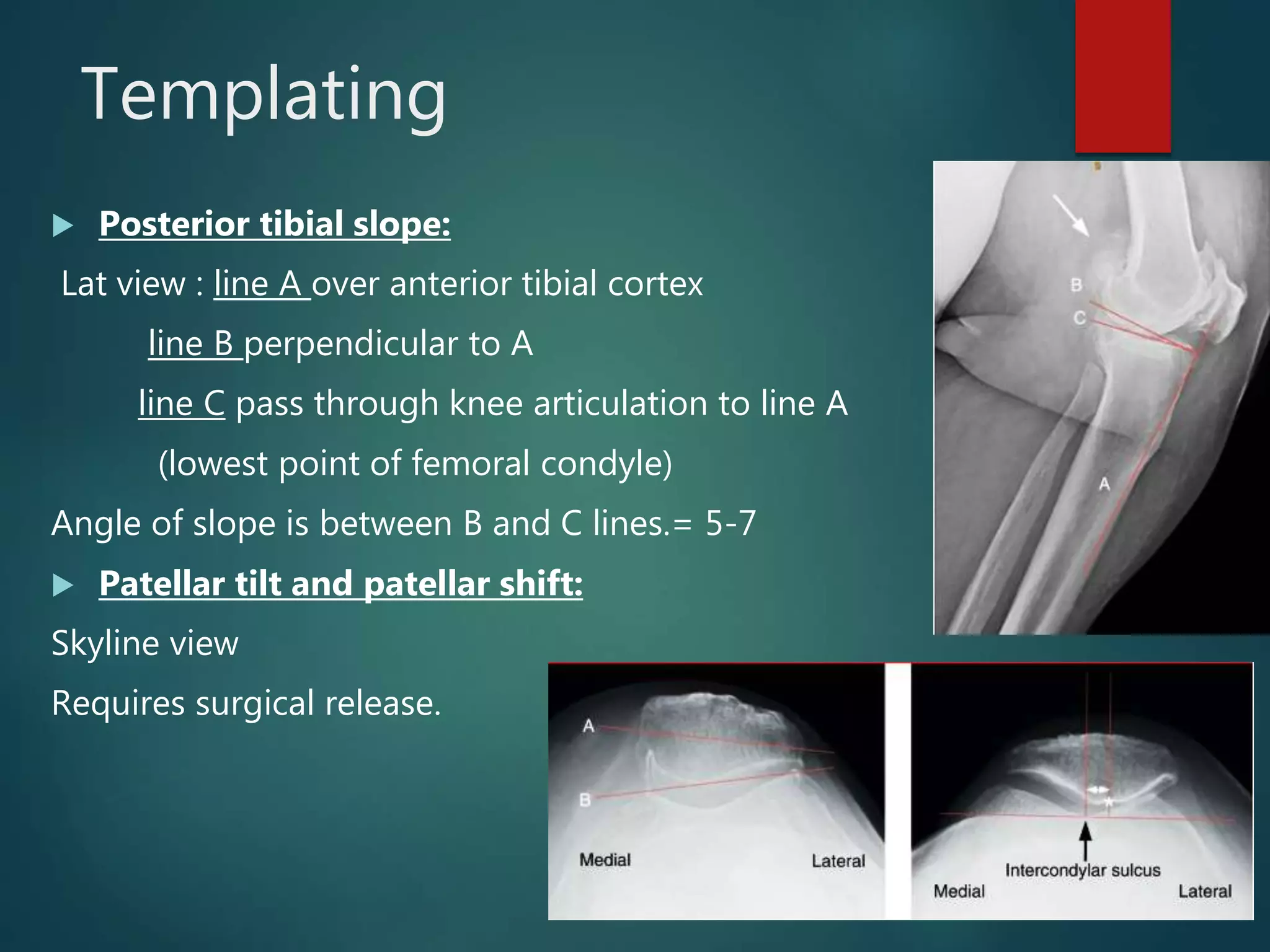 Preoperative preparation of total knee arthroplasty | PPTX