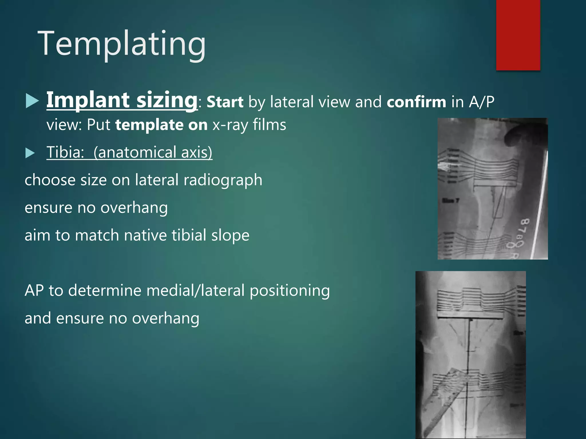 Preoperative preparation of total knee arthroplasty | PPTX