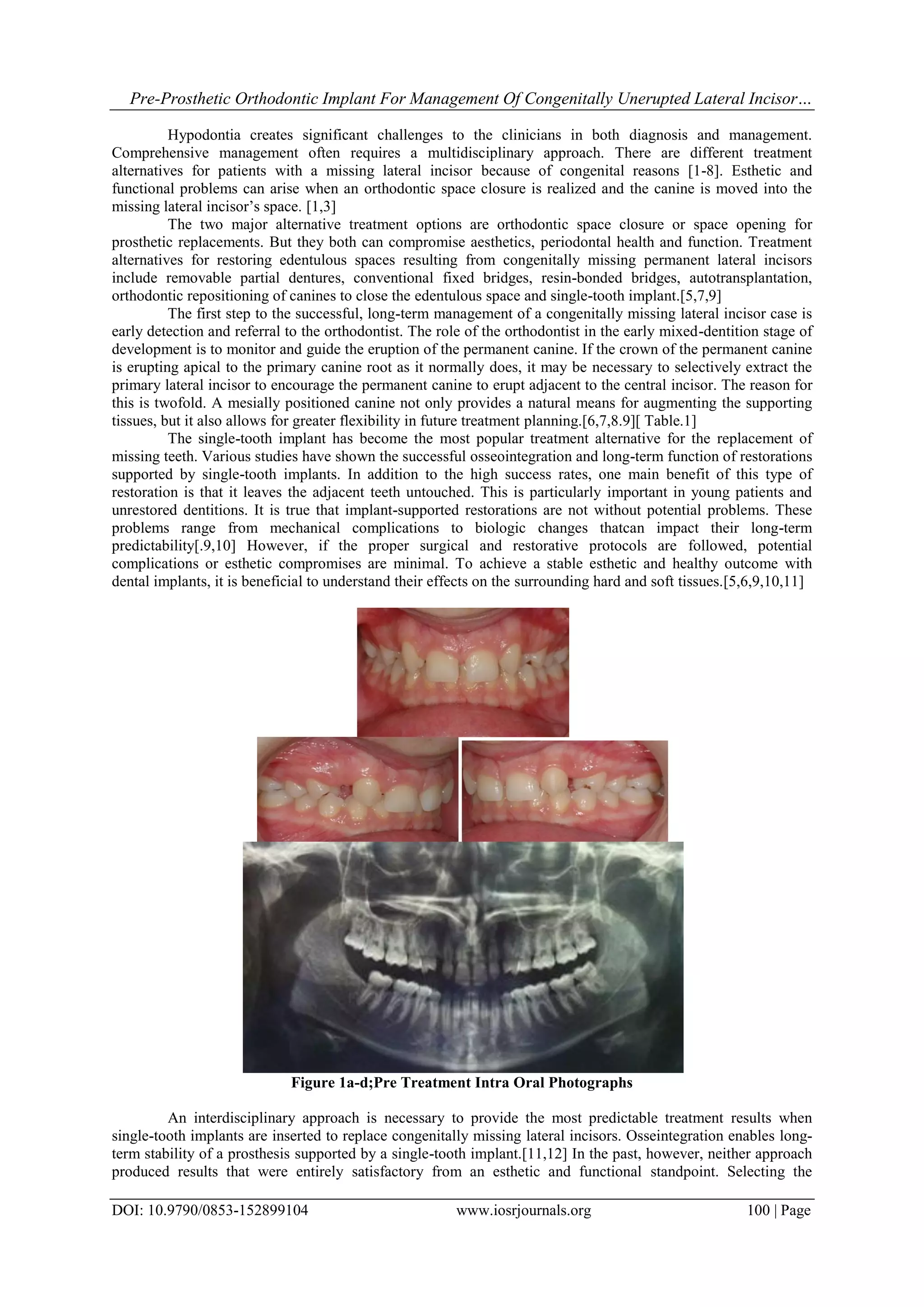 Pre prosthetic orthodontic implant for management of congenitally ...
