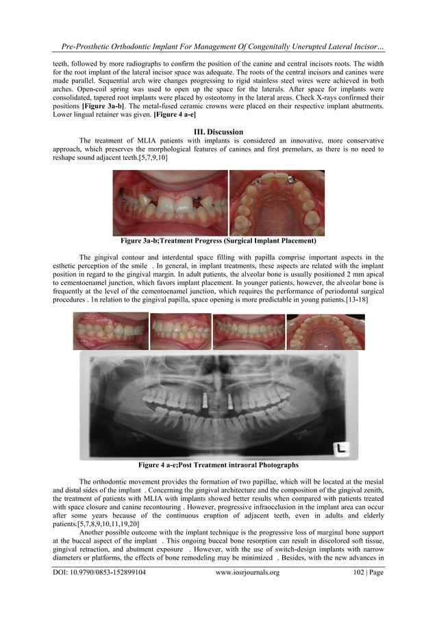 Pre prosthetic orthodontic implant for management of congenitally ...
