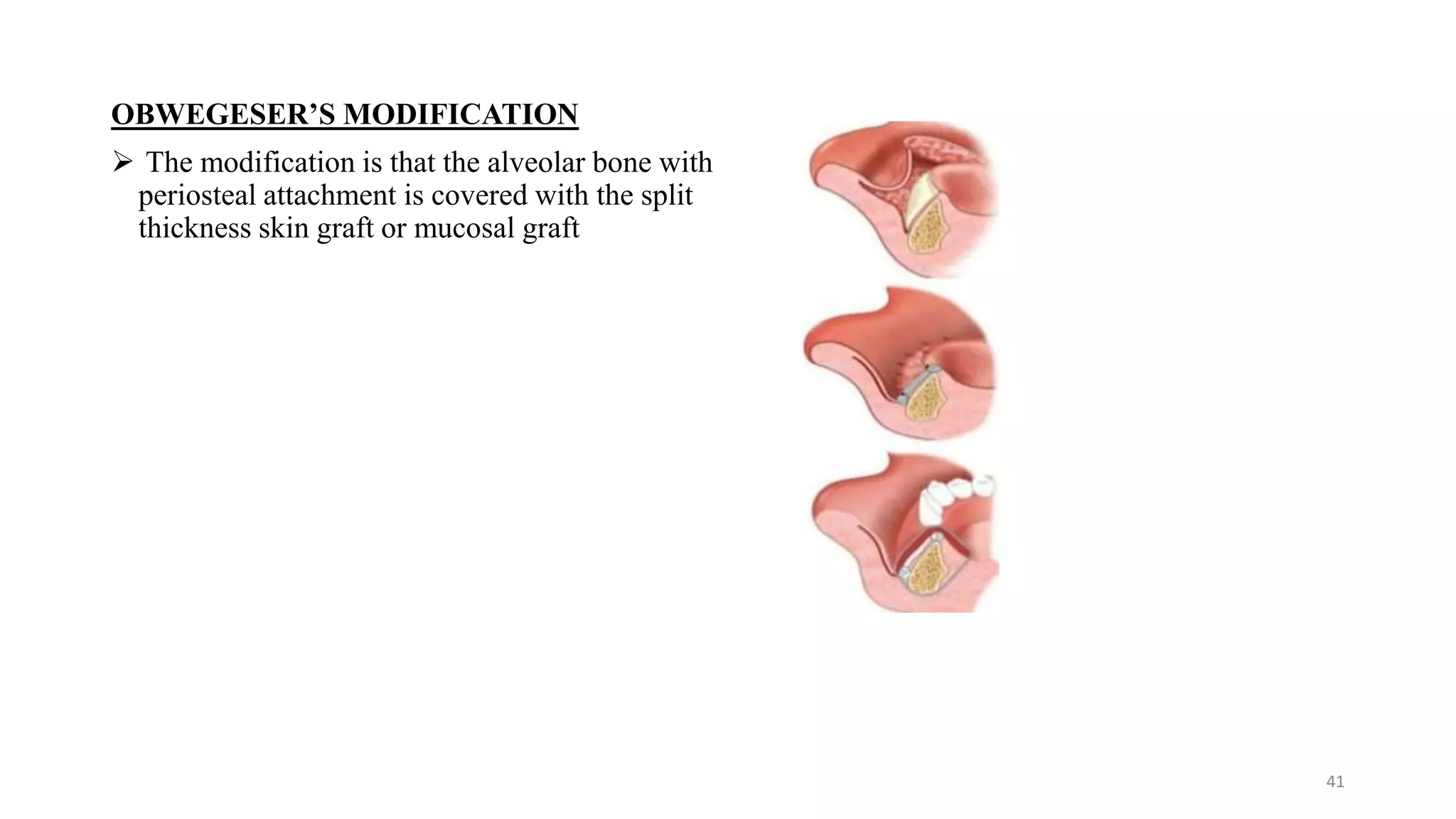 PRE-PROSTHETIC SURGERY.pptx