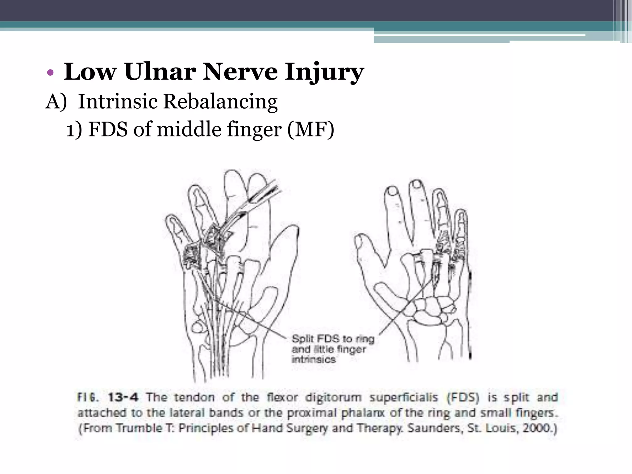 Pre and post operative management in tendon transfer | PPTX