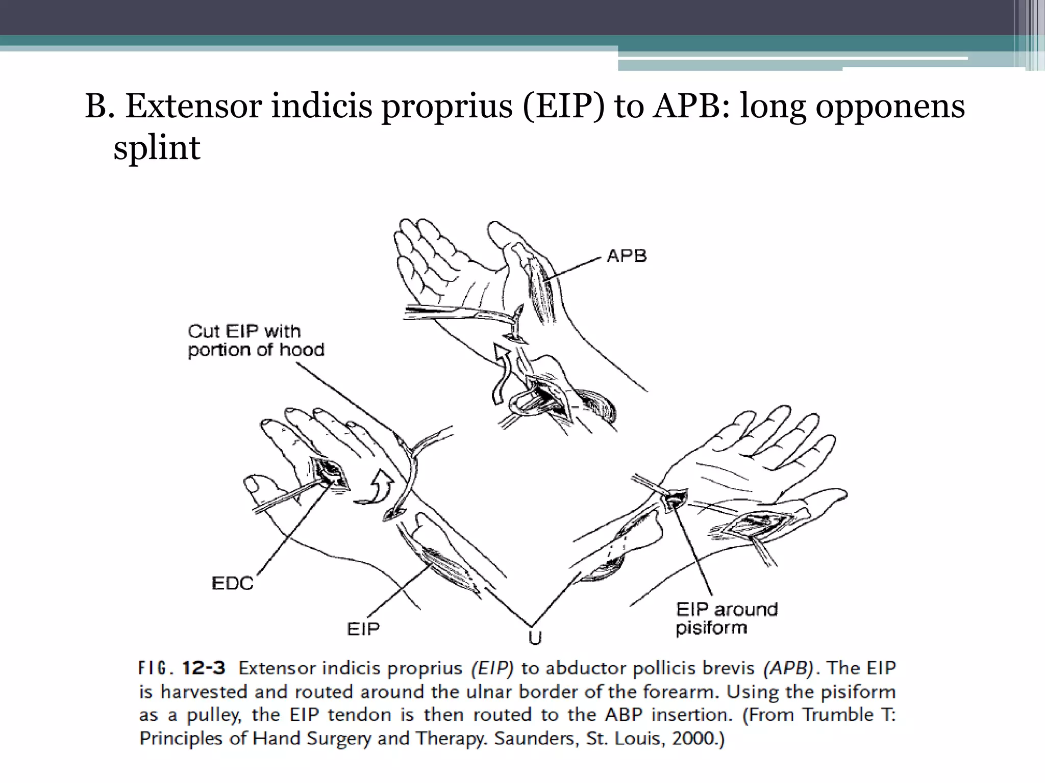 Pre and post operative management in tendon transfer | PPTX