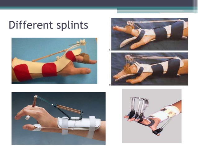 Pre and post operative management in tendon transfer | PPTX